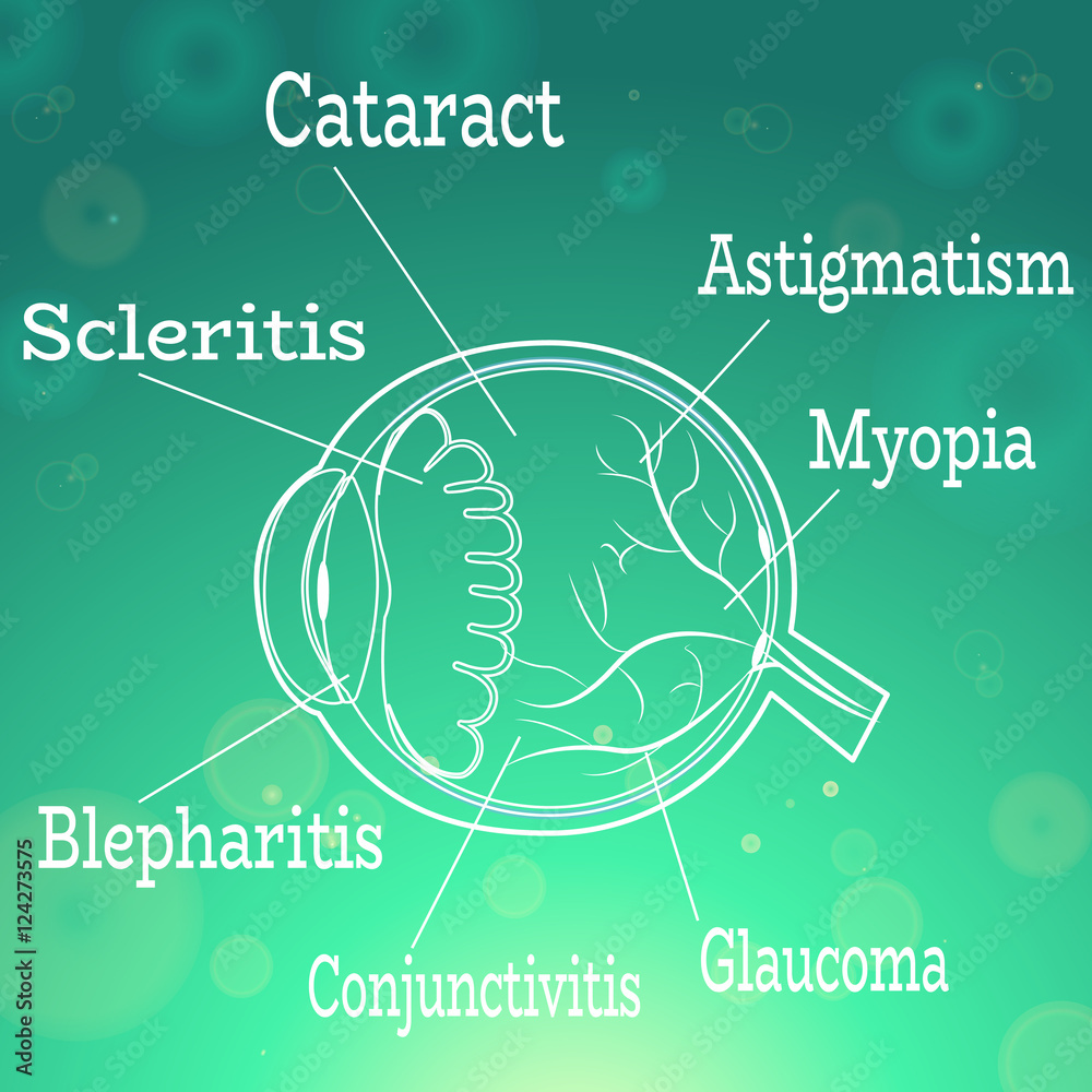 Human eye diseases anatomy structure.Medical infographics for ...