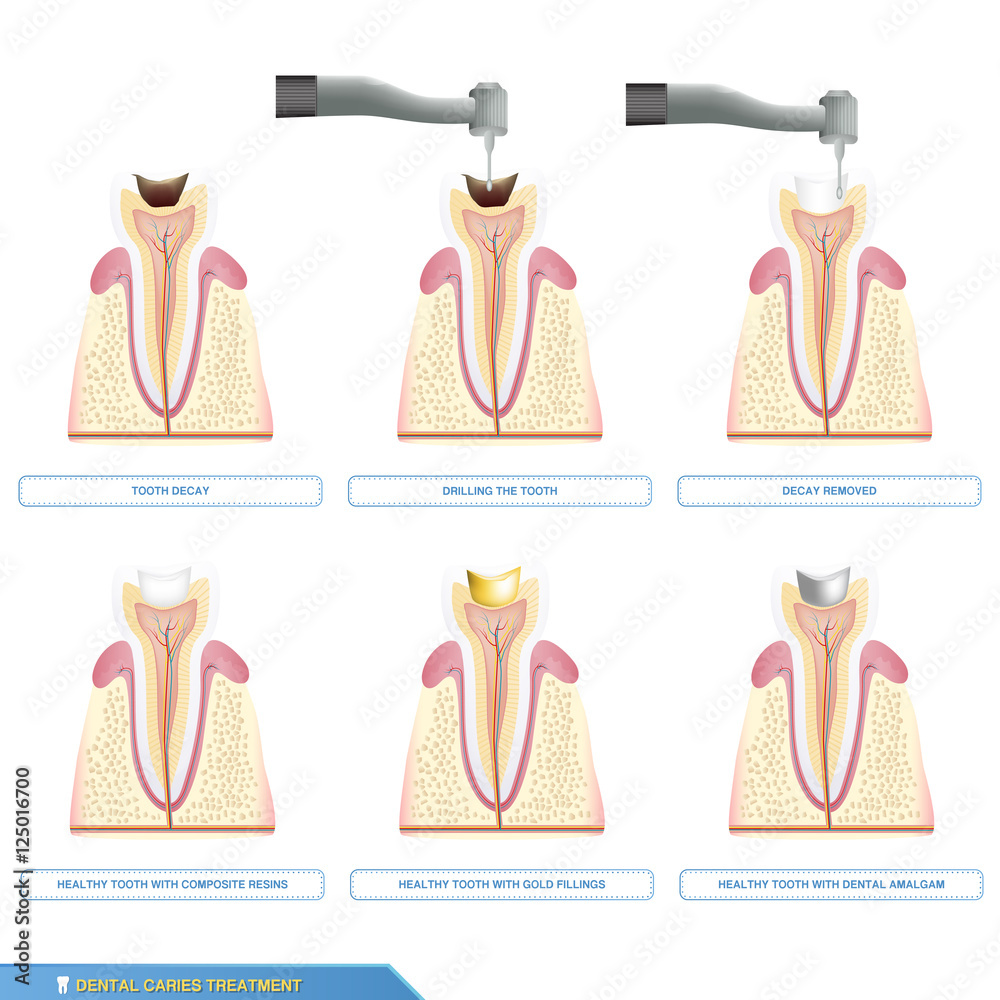 Infographics dental caries treatment and the different types of tooth ...