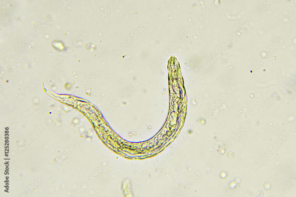 Strongyloides stercoralis (threadworm) in stool, analyze by microscope ...