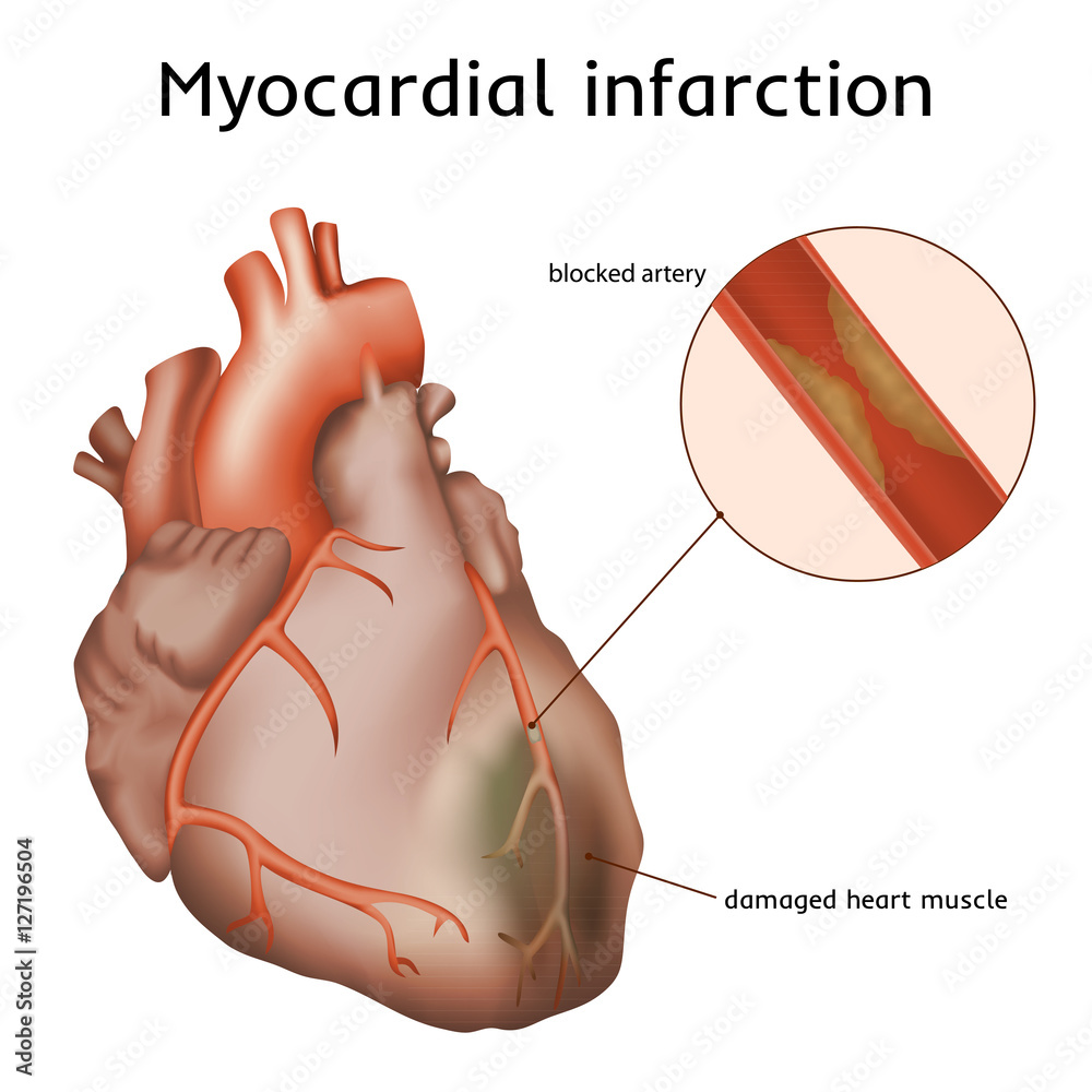 Myocardial infarction. Heart attack. Blocked artery, damaged heart ...