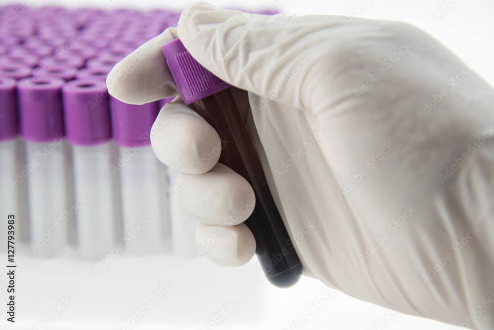 EDTA blood tube for CBC test in laboratory Stock Photo | Adobe Stock