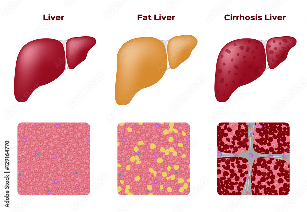 Normal liver Fatty liver and Cirrhosis liver vector Stock Vector ...