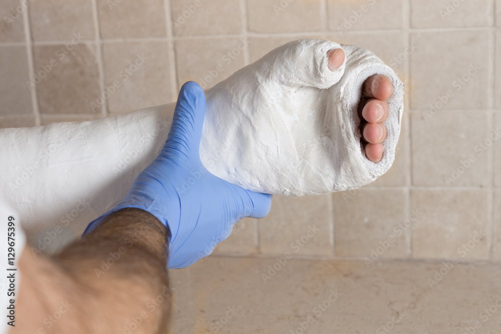 Orthopedic technician putting on a fiberglass plaster cast Stock Photo ...