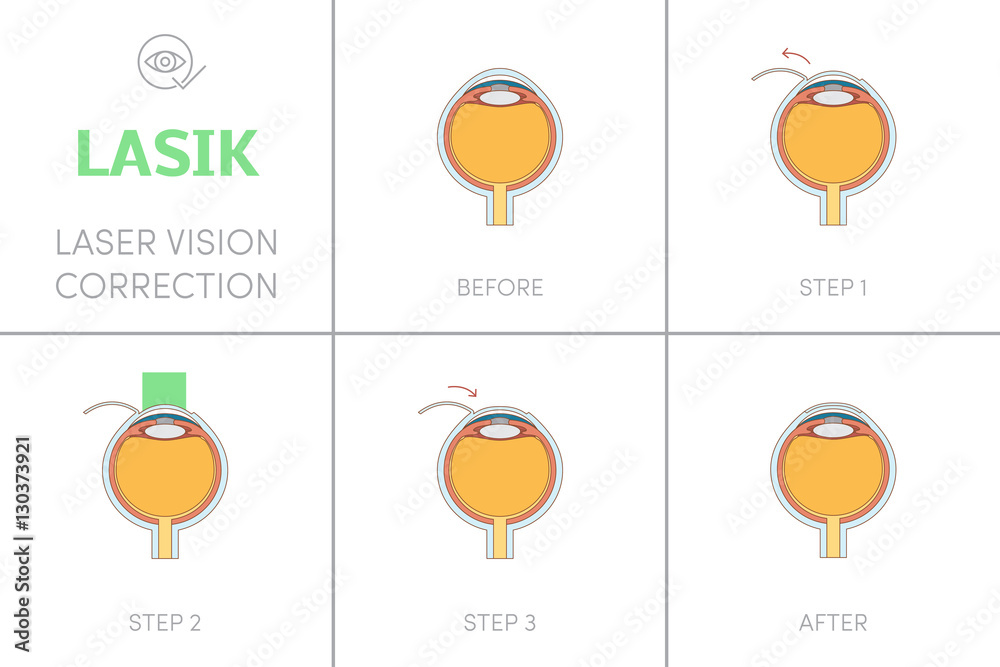 Stock-Illustration „Laser vision correction“ | Adobe Stock