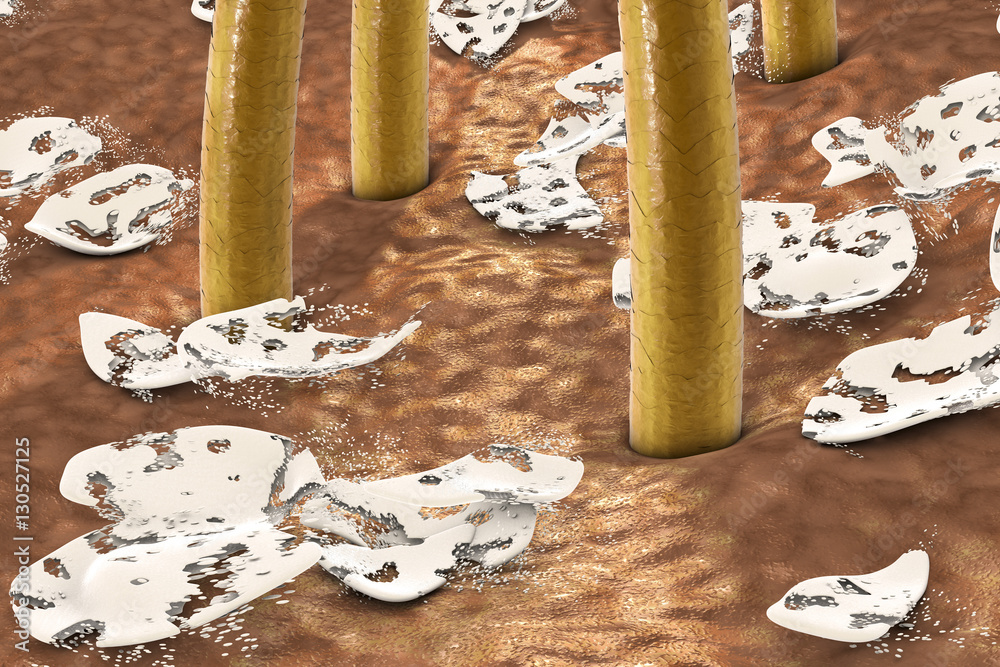 Destruction of dendruff, 3d illustration. Conceptual image for dandruff ...