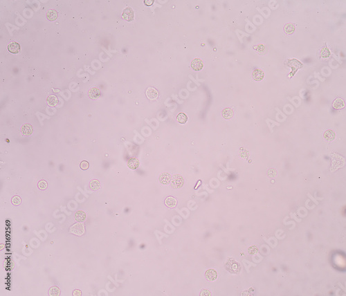 Bacteria in urine specimen under microscope 40x. - Buy this stock photo ...