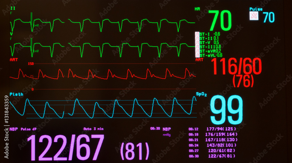 Monitor with EKG with paced rhythm (green line), arterial blood ...