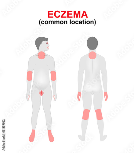 List 91 Pictures Eczema In Groin Area Pictures Stunning