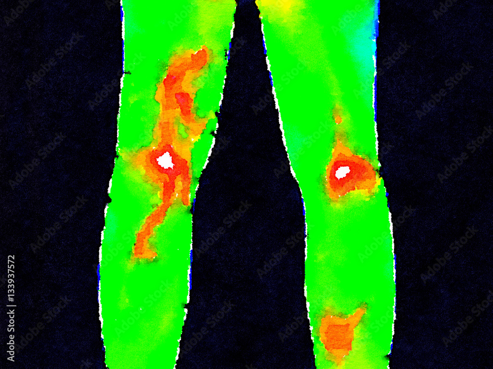 Foto de Stock Thermographic image of the backs of legs showing ...