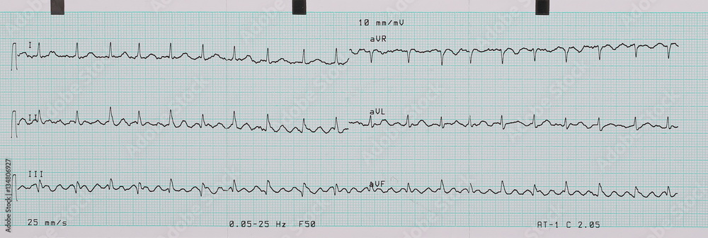 EKG printout background and texture Stock Photo | Adobe Stock