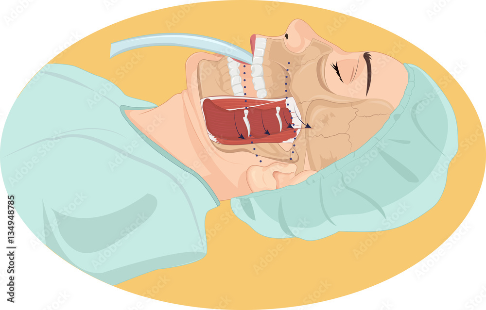 Vector illustration of Tracheal tube anatomy Stock Vector | Adobe Stock