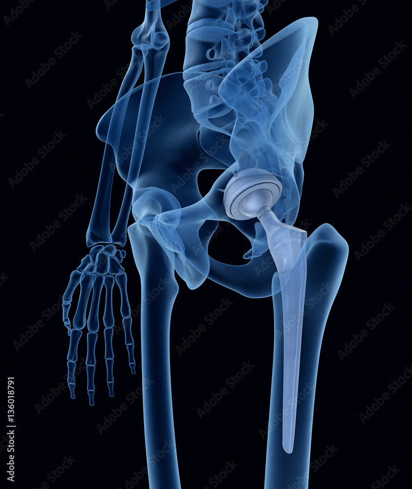 Hip replacement implant installed in the pelvis bone. X-ray view ...