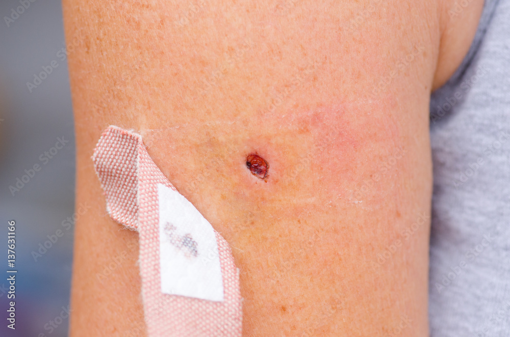 Bloody scab wound and band aid on skin Stock Photo | Adobe Stock