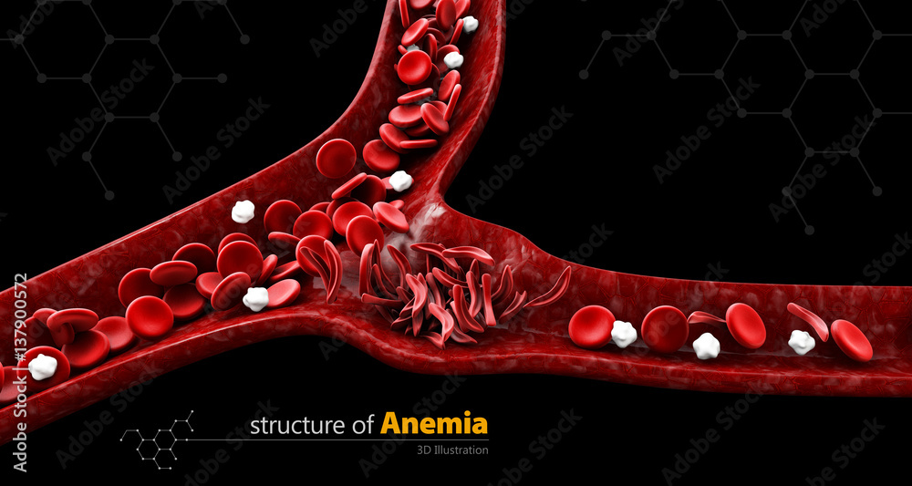 Sickle cell anemia, 3D illustration showing blood vessel with normal ...