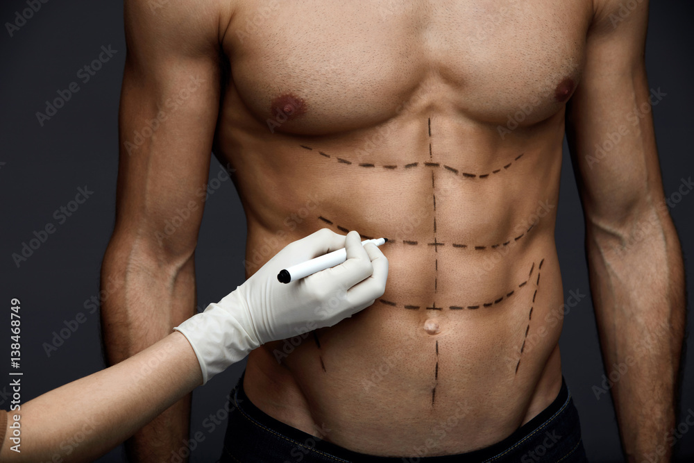 Male Body With Lines Before Beauty Operation. Plastic Surgery Stock ...
