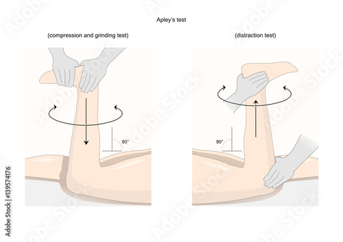 Apley test: evaluation of some problems of the knee - Buy this stock ...