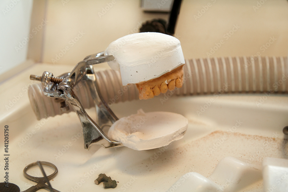 Стоковое фото «The plaster model of the jaws in articulator. Dental ...