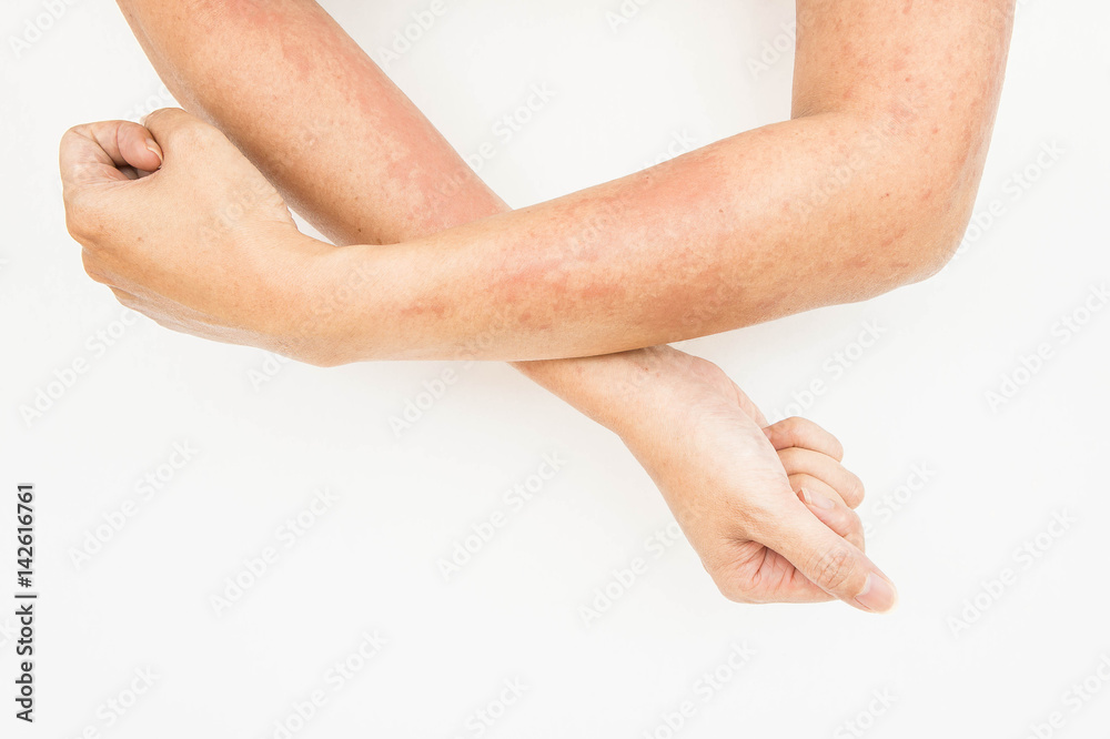 Skin rashes, allergies contact dermatitis ,allergic to chemicals ...