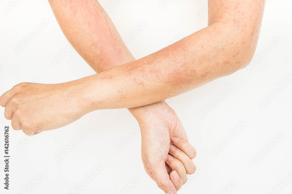 Skin rashes, allergies contact dermatitis ,allergic to chemicals ...
