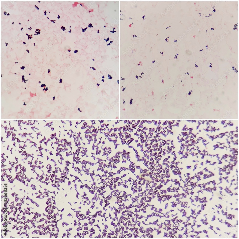 Smear of gram positive bacteria with cocci and bacilli shape, under ...