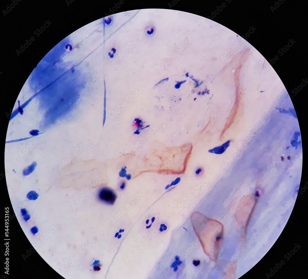 Smear of Acid-Fast bacilli (AFB) stained from sputum specimen with ...
