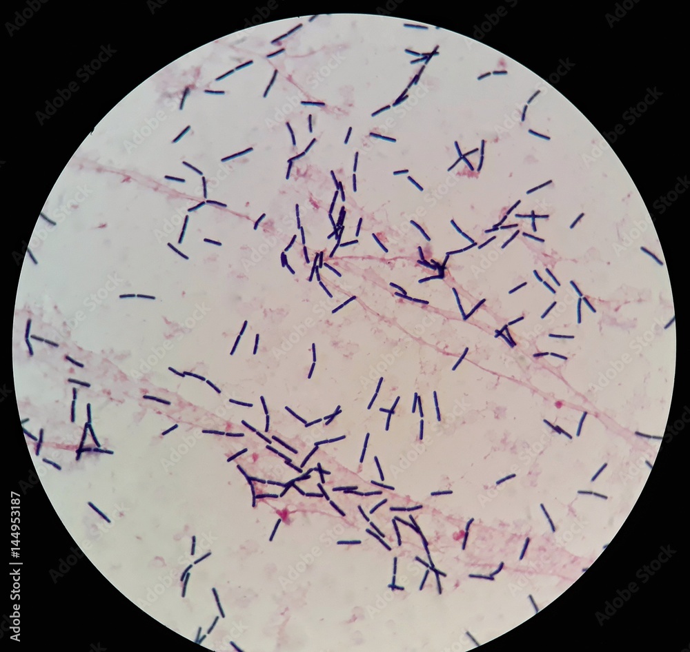 Smear of human blood culture Gram's stained with gram positive bacilli ...