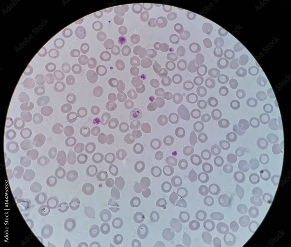 Human parasite under 100X light microscope; thin film of blood smear ...