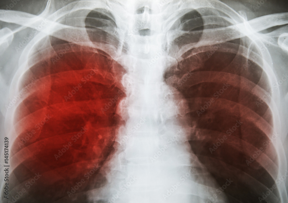 Pulmonary Tuberculosis ( TB ) : Chest x-ray show alveolar infiltration ...