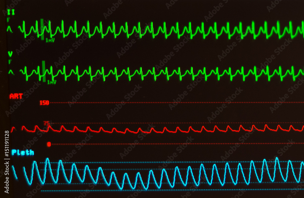 Foto de Stock Monitor showing atrioventricular nodal reentrant ...