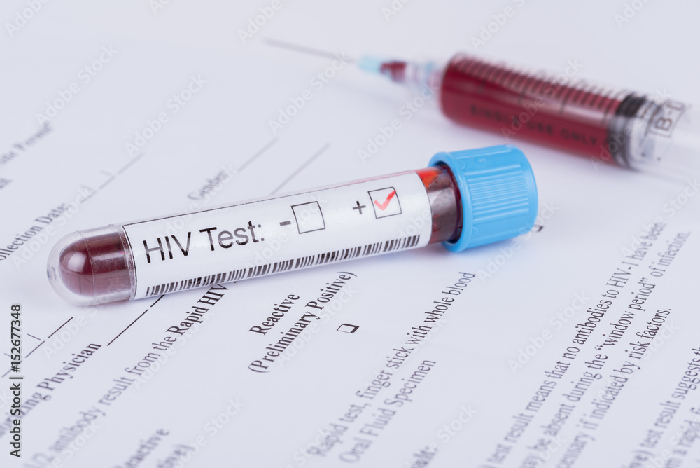 HIV positive test sample with medical forms Stock Photo | Adobe Stock