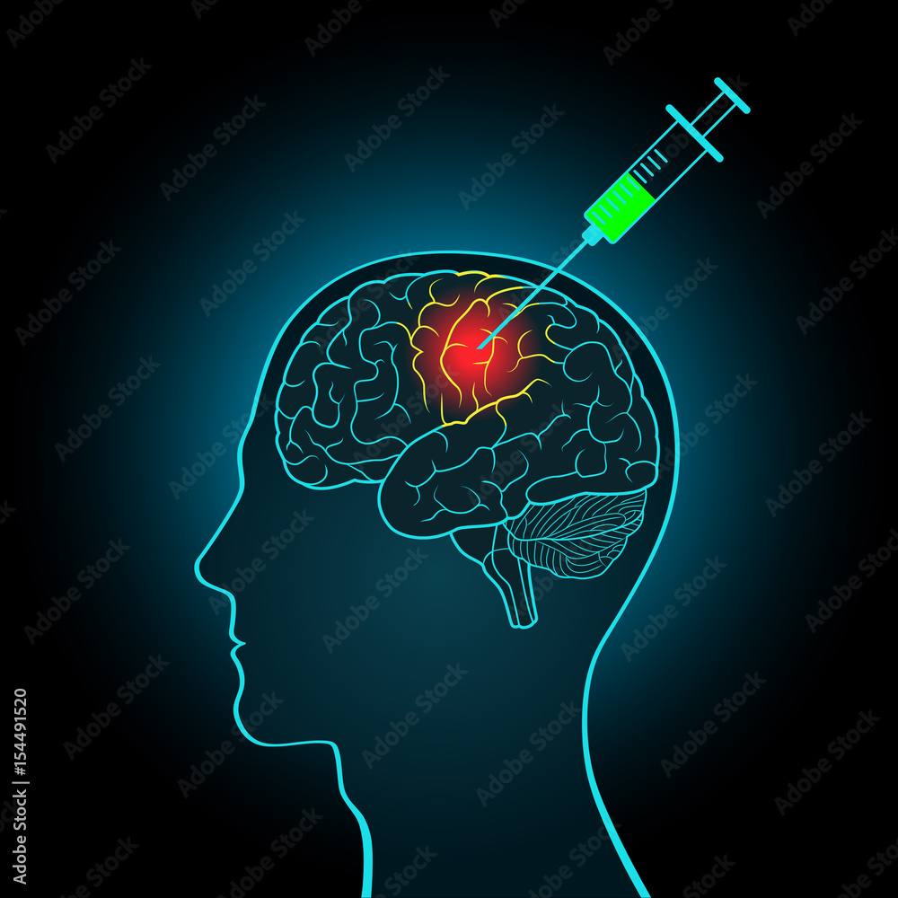 The injection syringe to the brain, the concept of direct treatment of ...