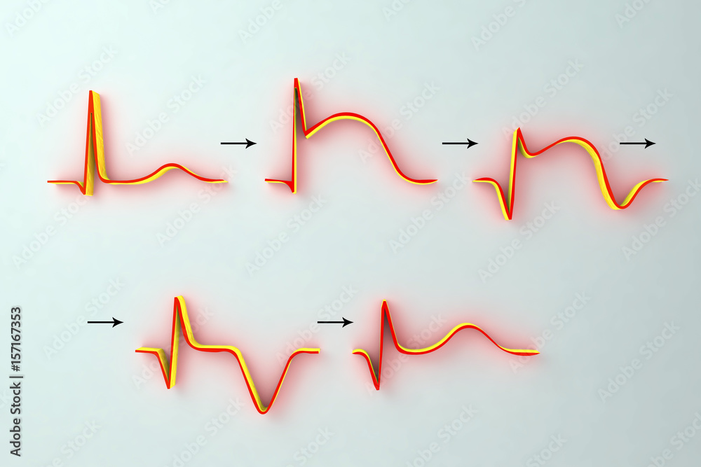 ECG in myocardial infarction. 3D illustration showing evolution of ECG ...