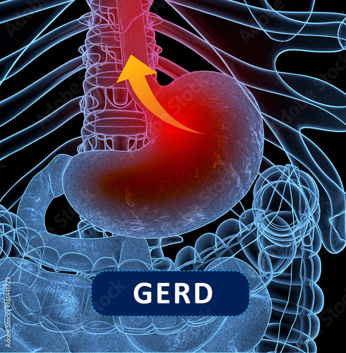 Acid Reflux Gerd Gastroesophageal Reflux Disease Diagram With Title