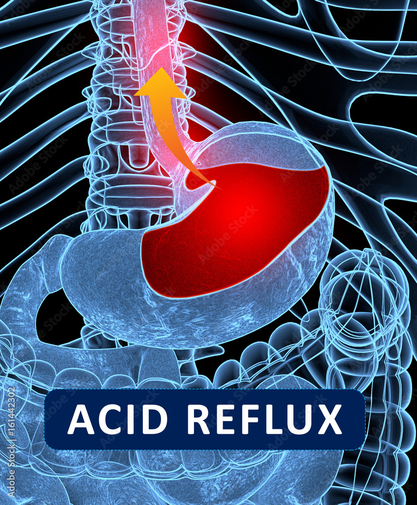 Acid reflux, GERD. Gastroesophageal reflux disease. Diagram with title ...