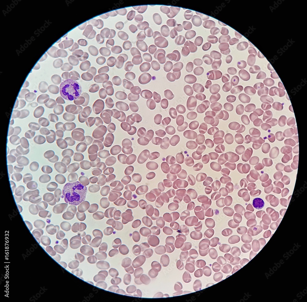 Human blood smear with abnormal red blood cells morphology call ...