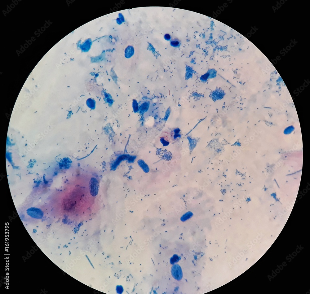 Stock-Foto „Smear of Acid-Fast bacilli (AFB) stained from sputum ...