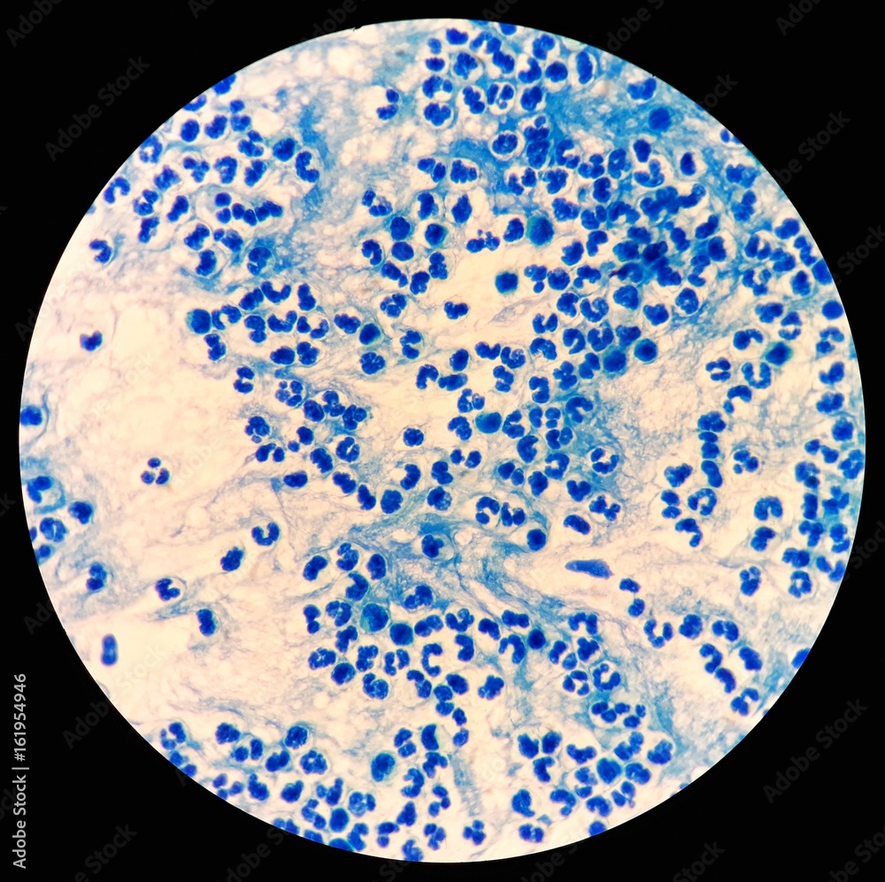 Foto de Stock Smear of Acid-Fast bacilli (AFB) stained from sputum ...