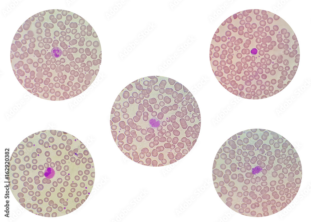 Blood smear under microscope present neutrophil, lymphocyte, monocyte ...