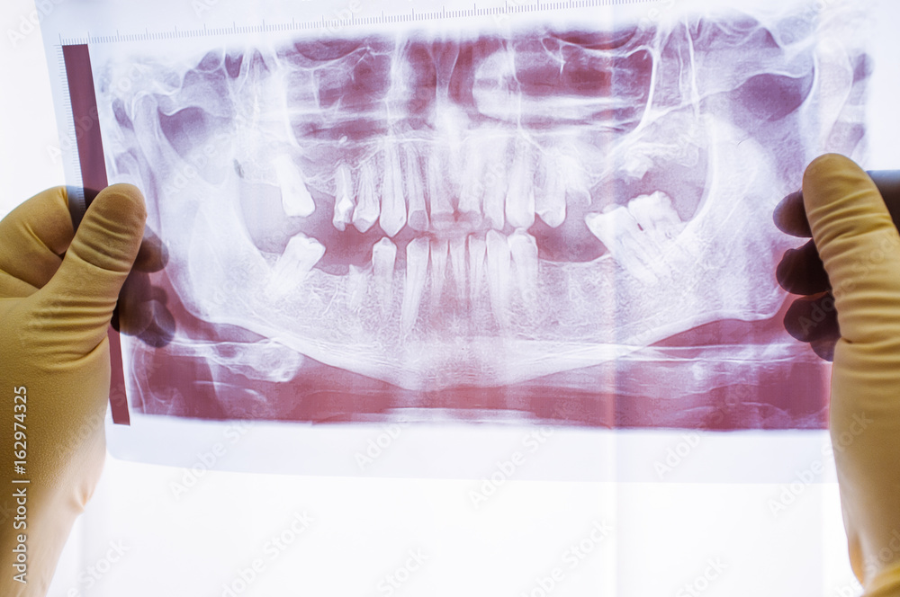 Dental x-ray with periodontitis problems, lost teeth and caries ...