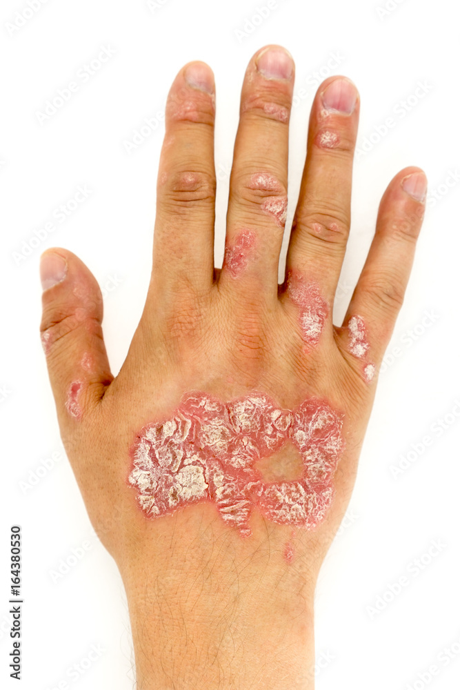 Psoriasis vulgaris on the man hand and finger nails with plaque, rash ...