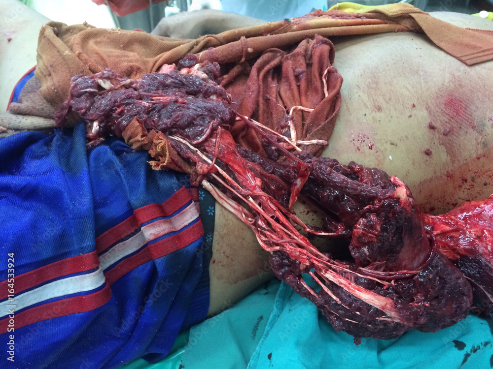 Amputation wound injury left forearm. Stock Photo | Adobe Stock