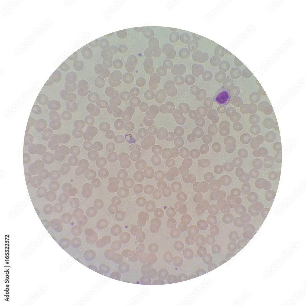 Microscopic examination of thin blood films smear from malaria infected ...