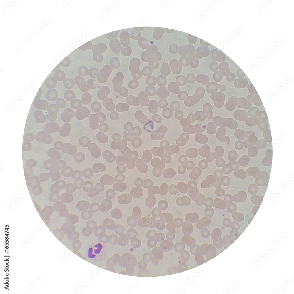 Microscopic examination of thin blood films smear from malaria infected ...