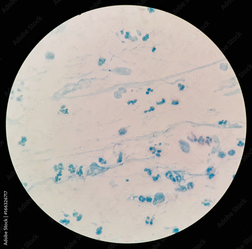 Poor smear staining quality of Acid-Fast bacilli (AFB) stained from ...
