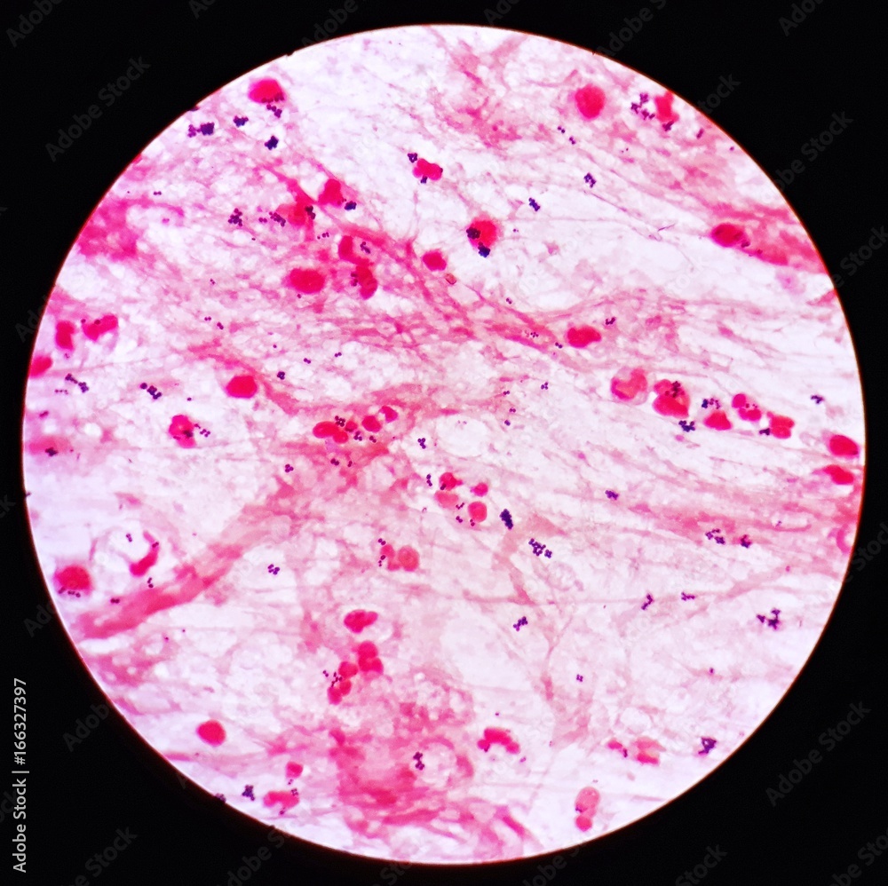 Smear of sputum specimen Gram's stained under 100X light microscope ...
