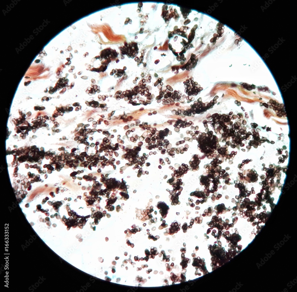 Fotografie Smear from tissue biopsy Giemsa stained under 100X light ...