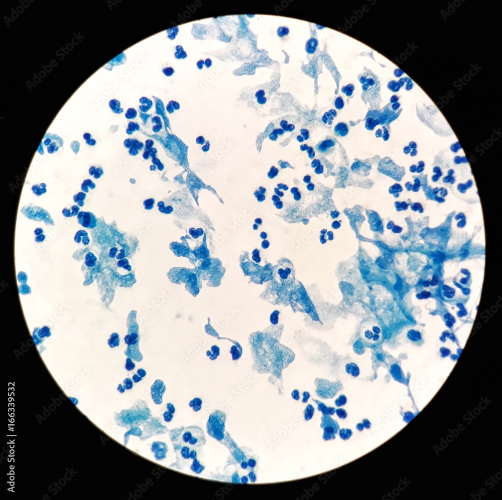 Smear of Acid-Fast bacilli (AFB) stained from sputum specimen with ...