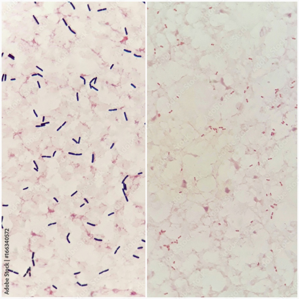 Two smear patterns of human blood cultured Gram's stained with gram ...