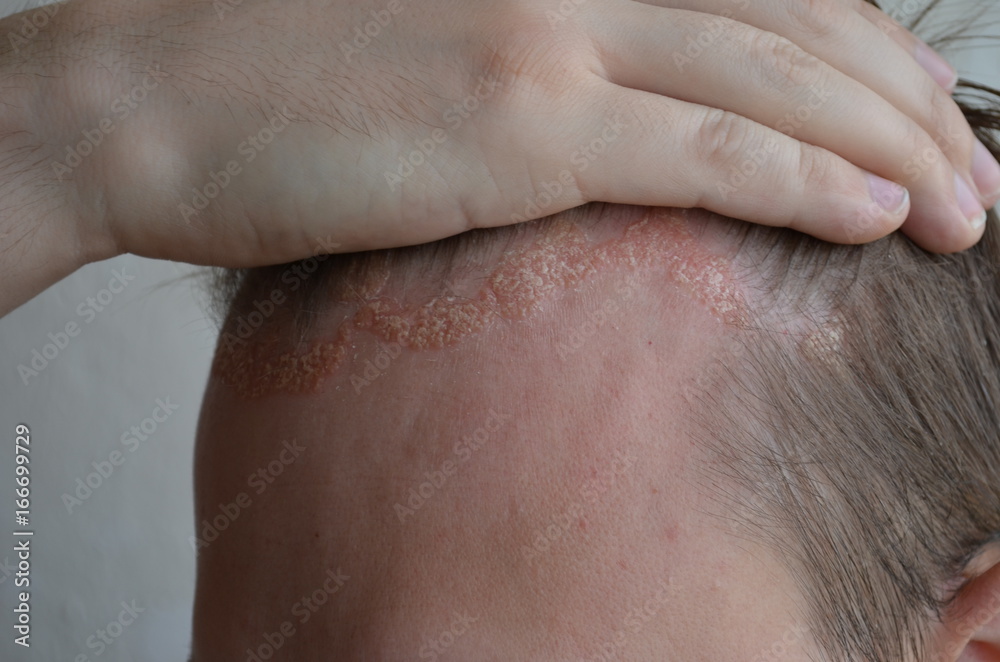 Psoriasis on the skin close-up, scalp, photos of dermatitis and eczema ...