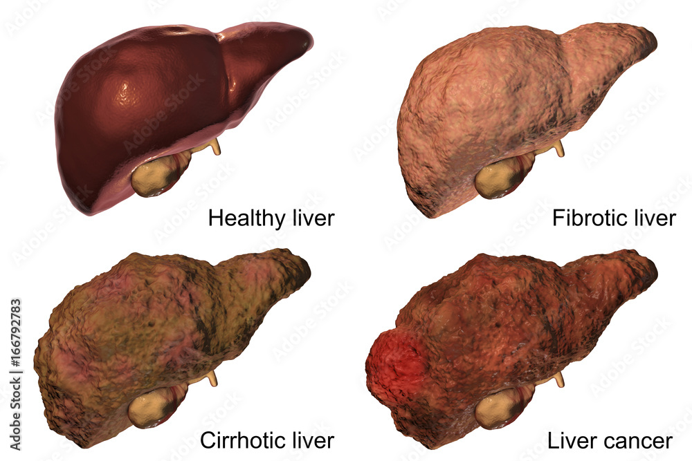 Liver disease progression in Hepatitis B and C viral infection, 3D ...